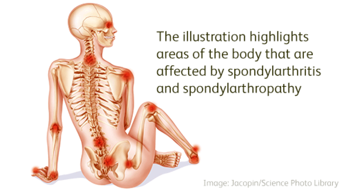 Spondyloarthritis (Part 1) | The Chartered Society of Physiotherapy